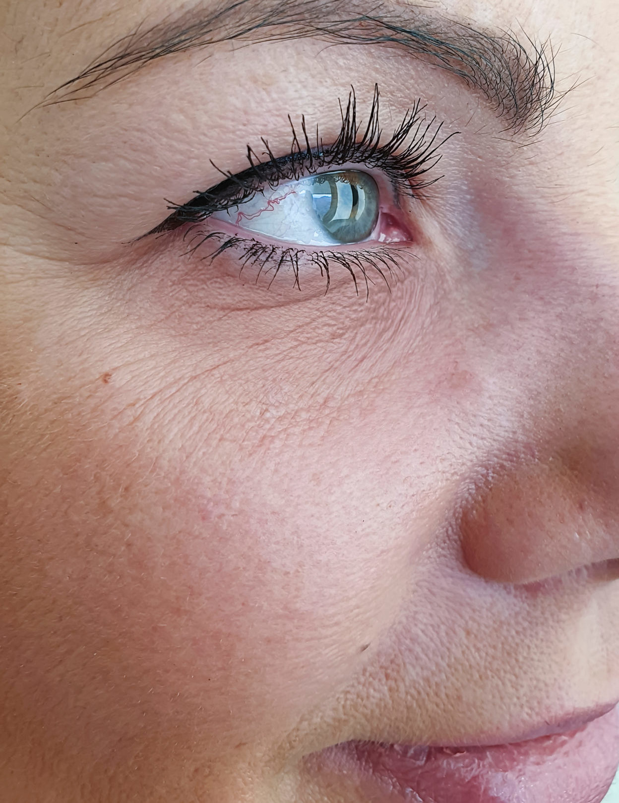 Profhilo - Dr Nicky Naylor